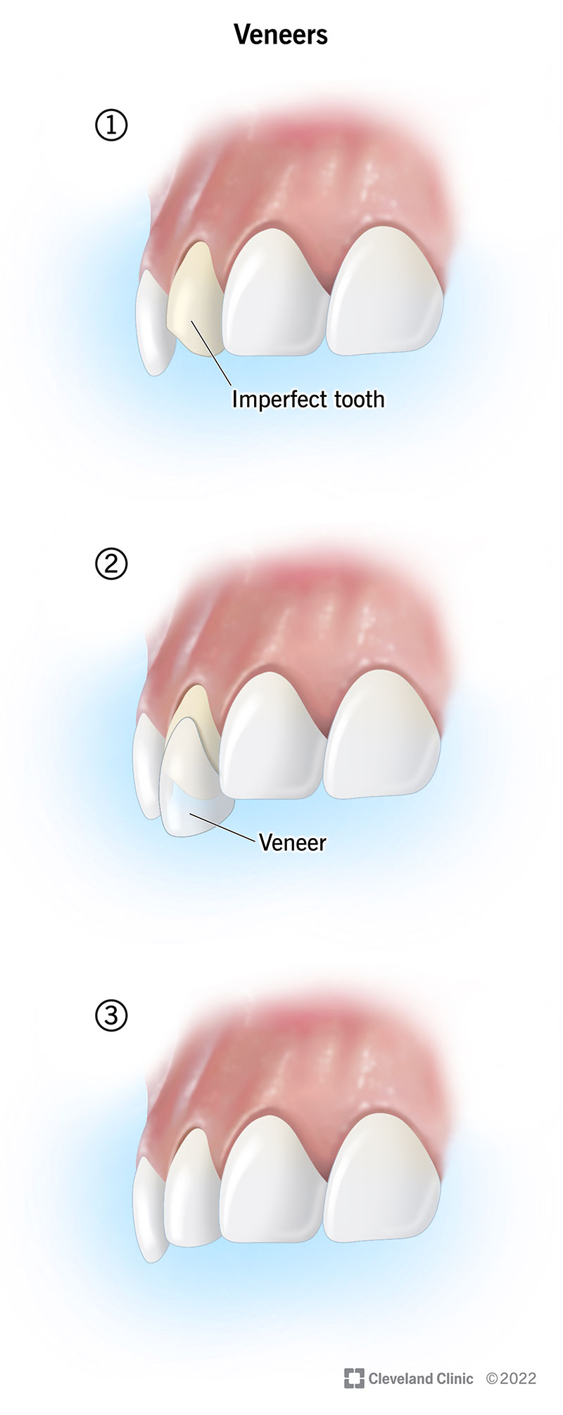 Dental Veneers – Coral Dental Implants